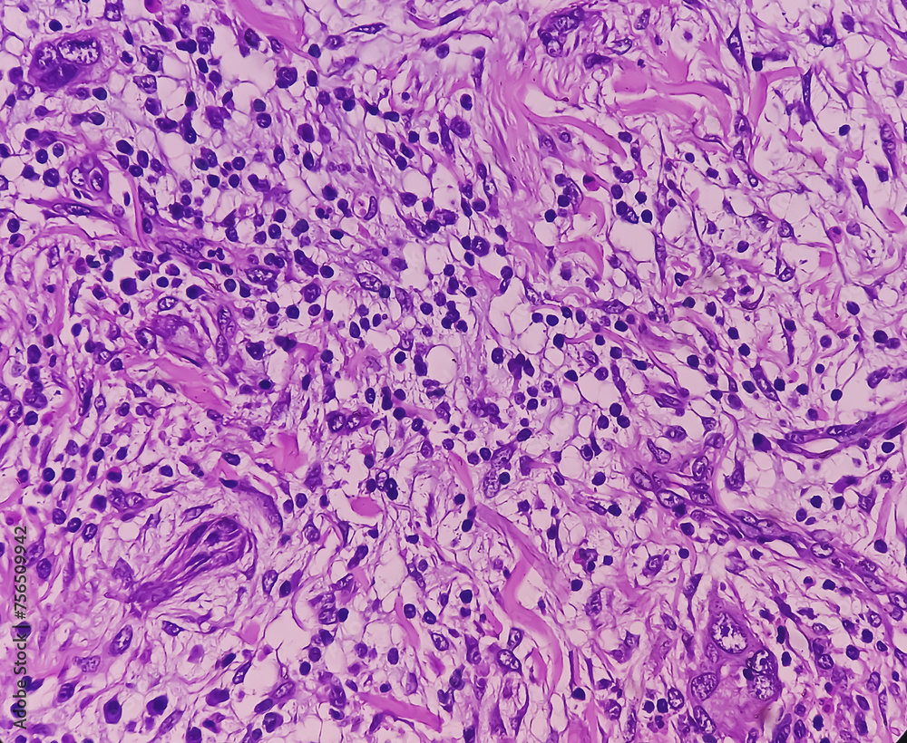 Tissue from axilla (biopsy). Invasive squamous cell carcinoma. Smear ...