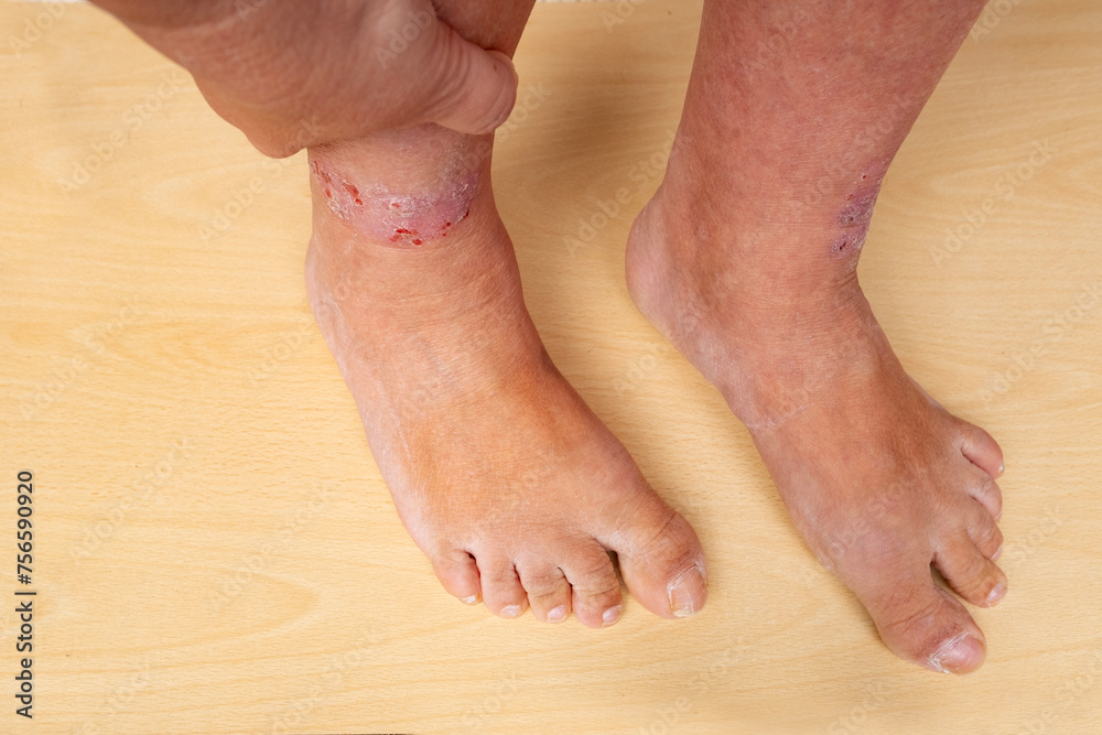 rash, hives, itchy skin on legs, inflammation and allergy, disease on ...