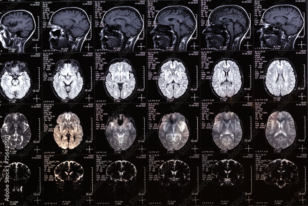 MRI, MRT, CT scan image of human brain. Medical treatmant concept ...
