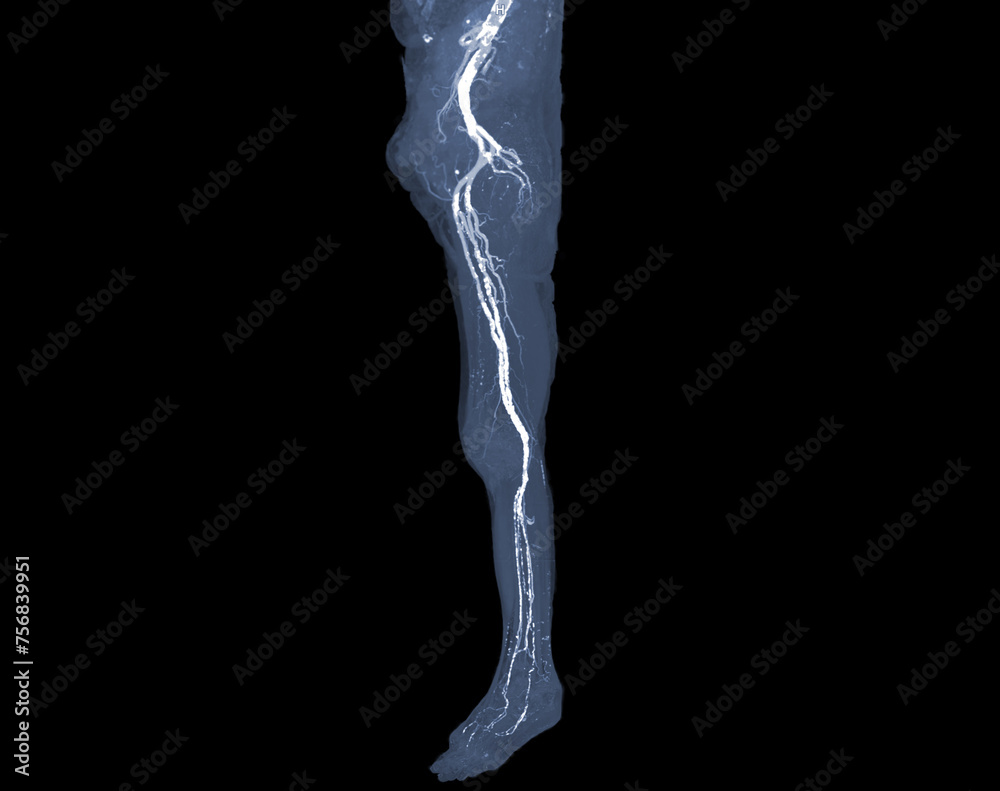CTA femoral artery run off image of femoral artery for diagnosis Acute ...