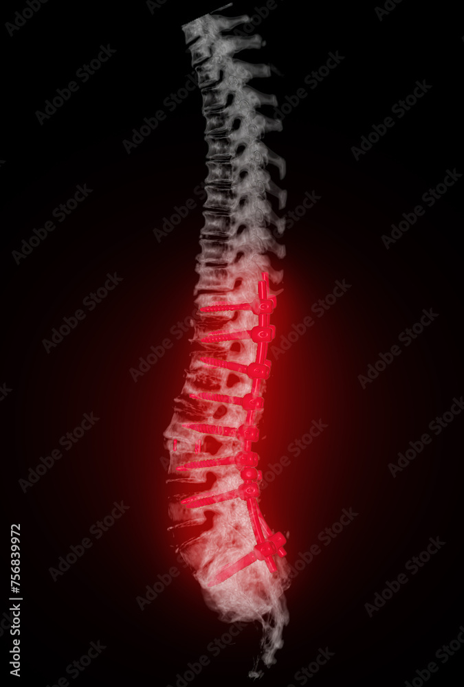 CT scan of thoracic and lumbar spine 3d rendering showing pedicle screw ...