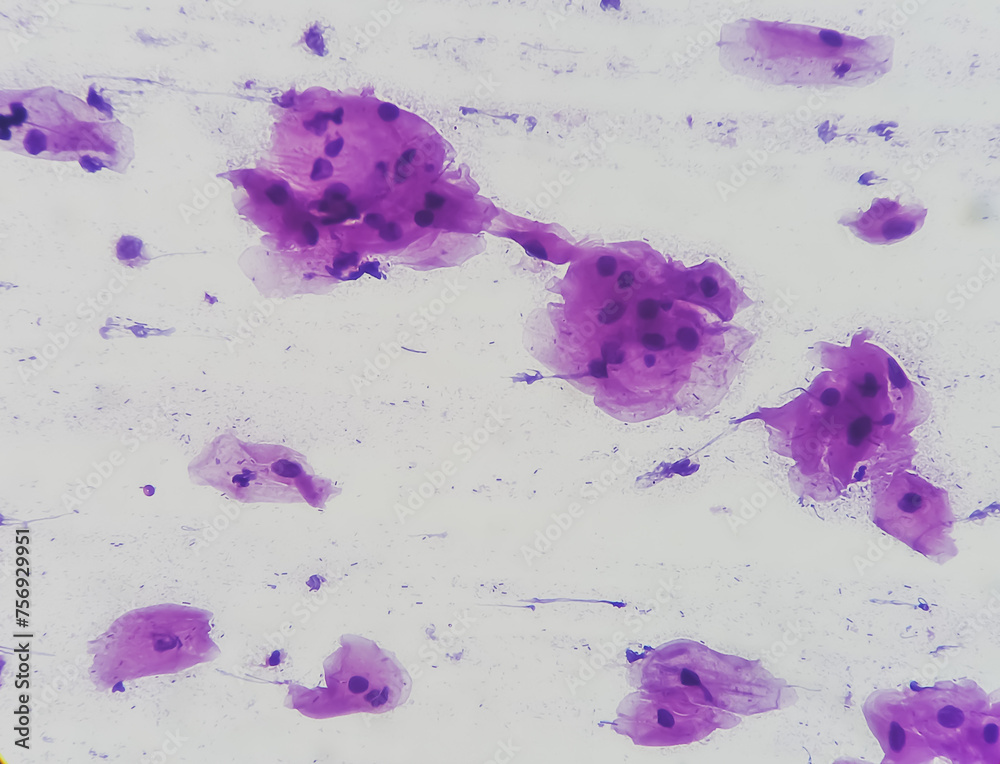 Light micrograph of Paps smear: Inflammatory smear with HPV related ...