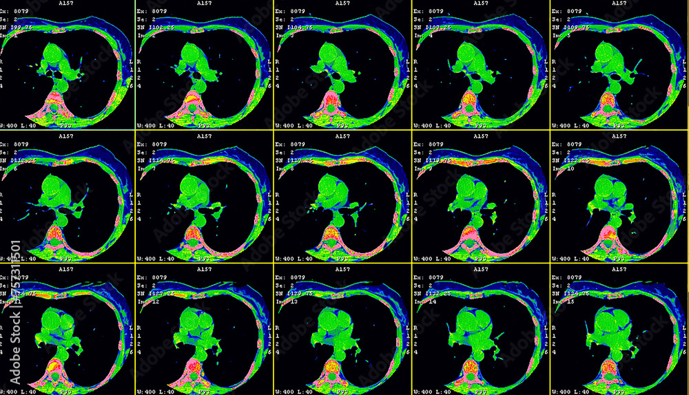 Axial contrast of the cardio system with radiology. A computerized ...