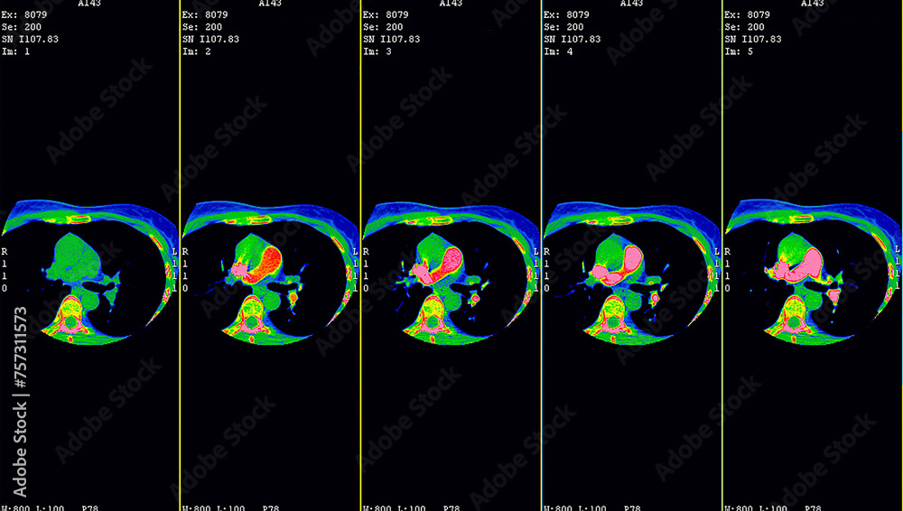 Axial images showing a thymic carcinoma CT cardiac scan. Computer ...