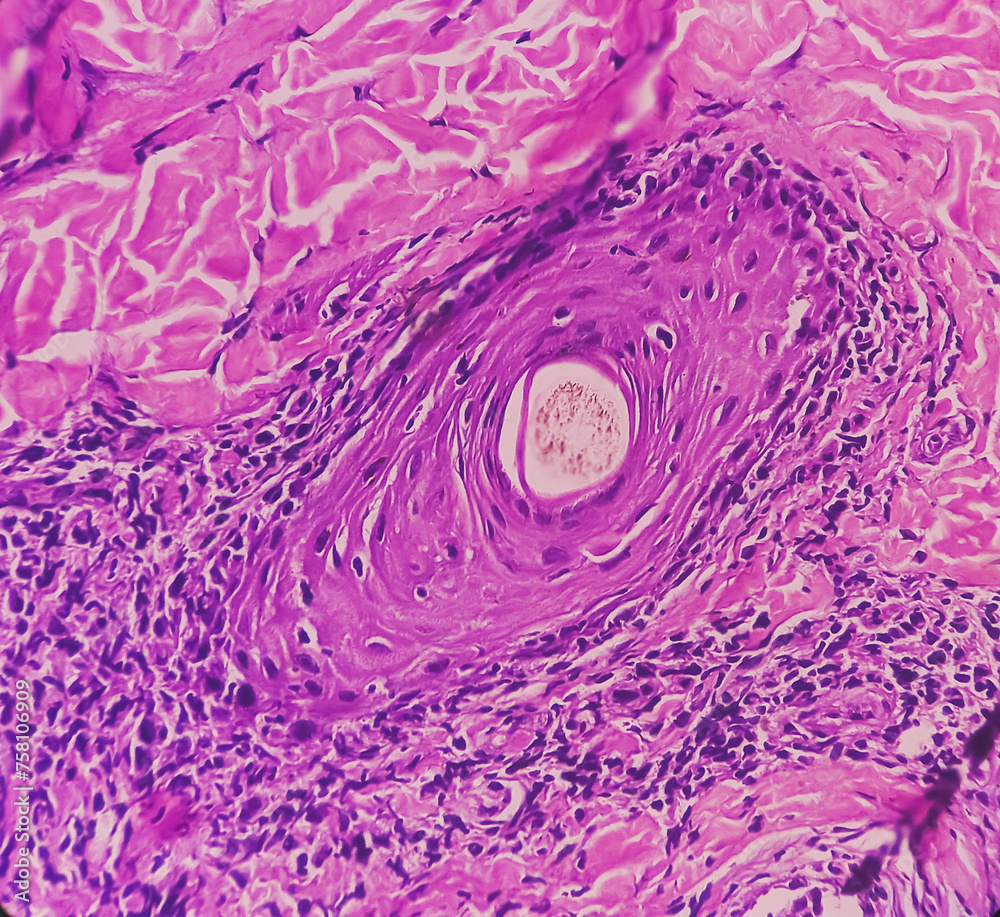 Skin tissue biopsy: Lichen planus. show skin tissue, epidermis show ...