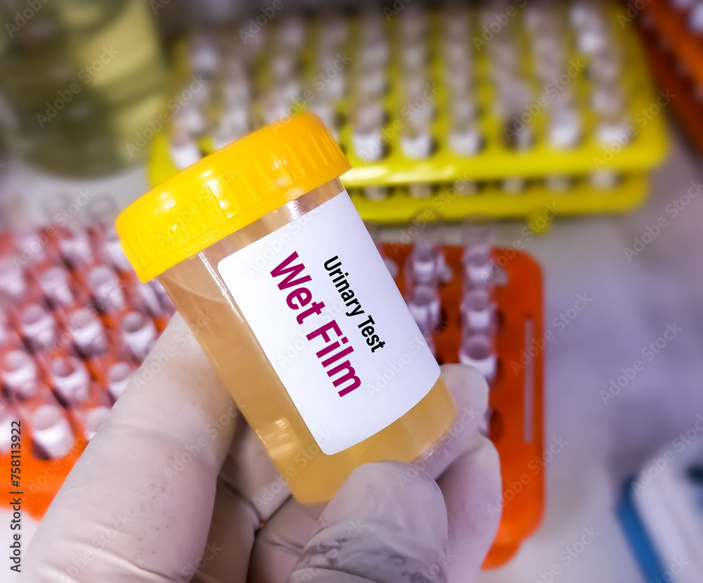 Urine analysis test sample for wet film, for the identification of ...