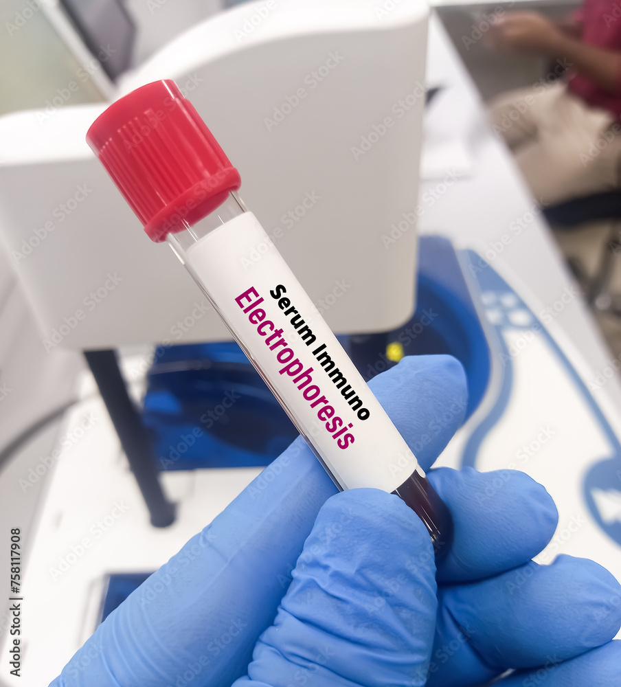 Blood sample for serum immuno electrophoresis (IEP) test, used to ...