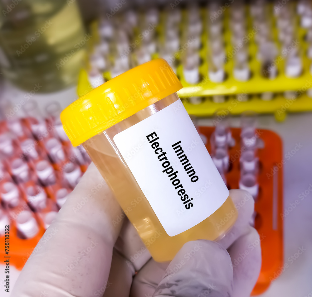 Urine sample for Immuno electrophoresis test (IEP), to identify ...