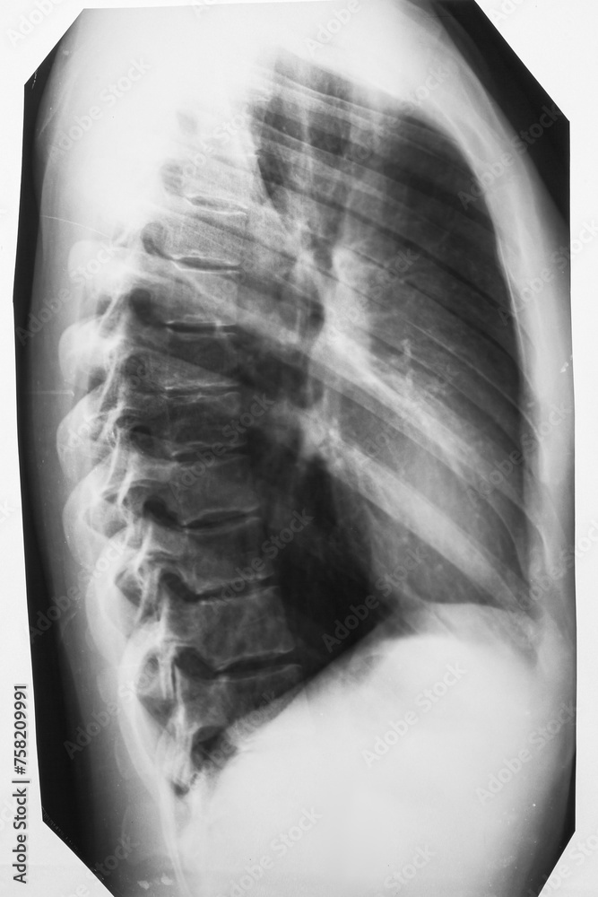 Chest x-ray photo of woman, with lungs, thoracic spine and thoracic ...