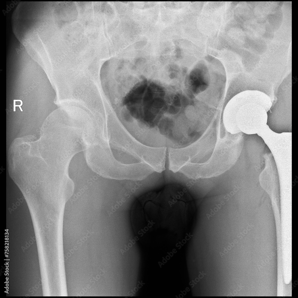 Left femoral neck fracture. Right femur. X-ray photo of man ...