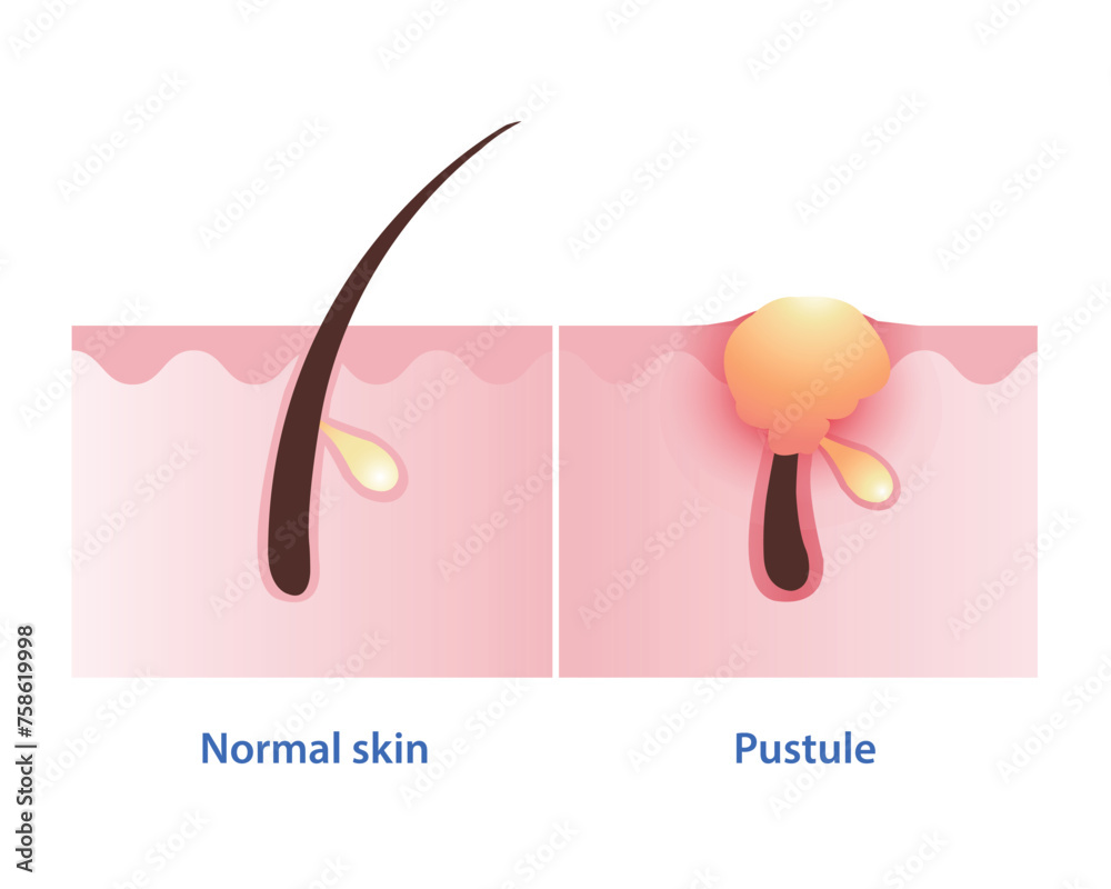 Pustule, type of inflammatory acne develop from papule vector on white ...