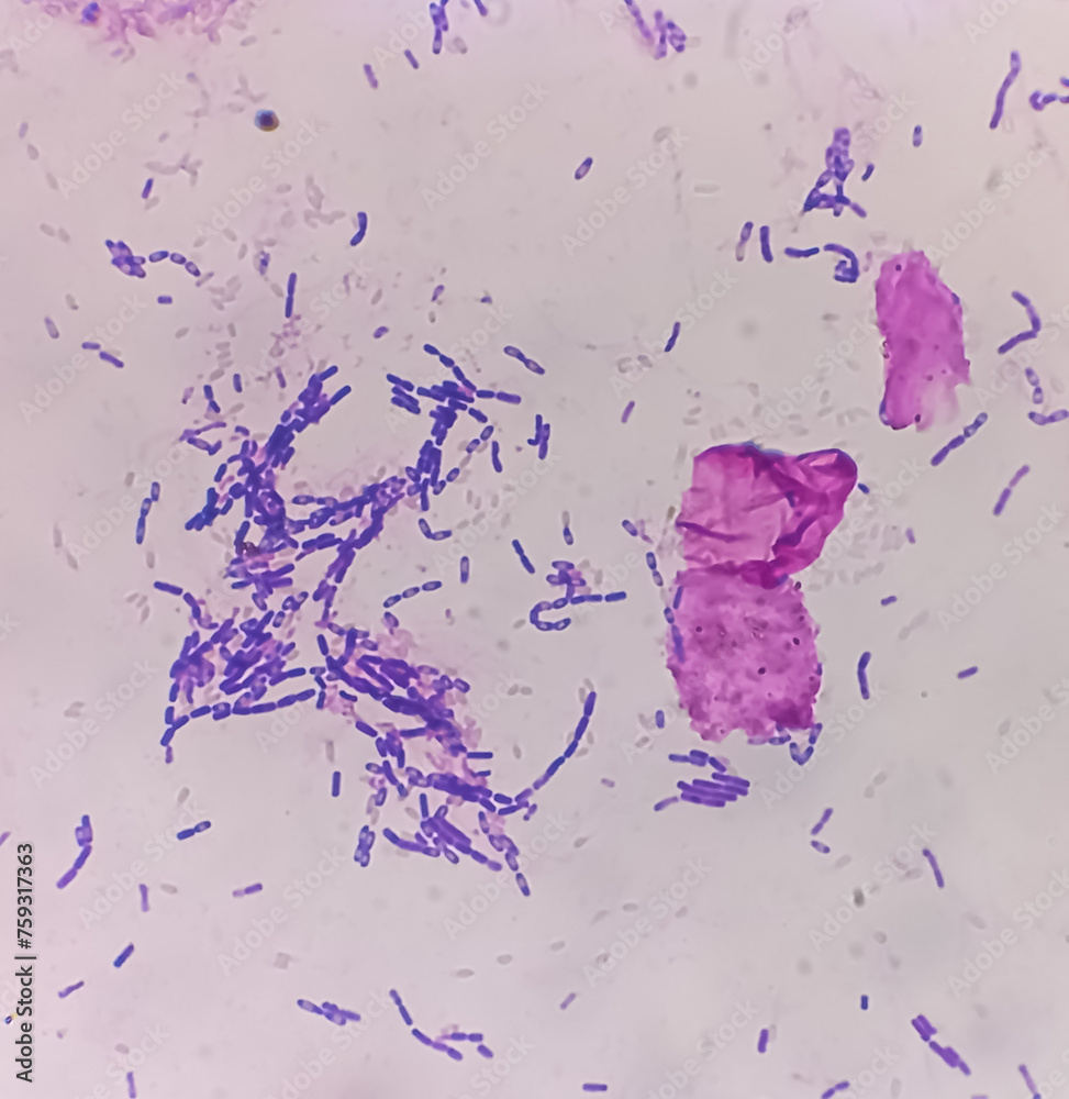 Foto de Stock Yeast Infection; Budding yeast and pseudohyphae of ...