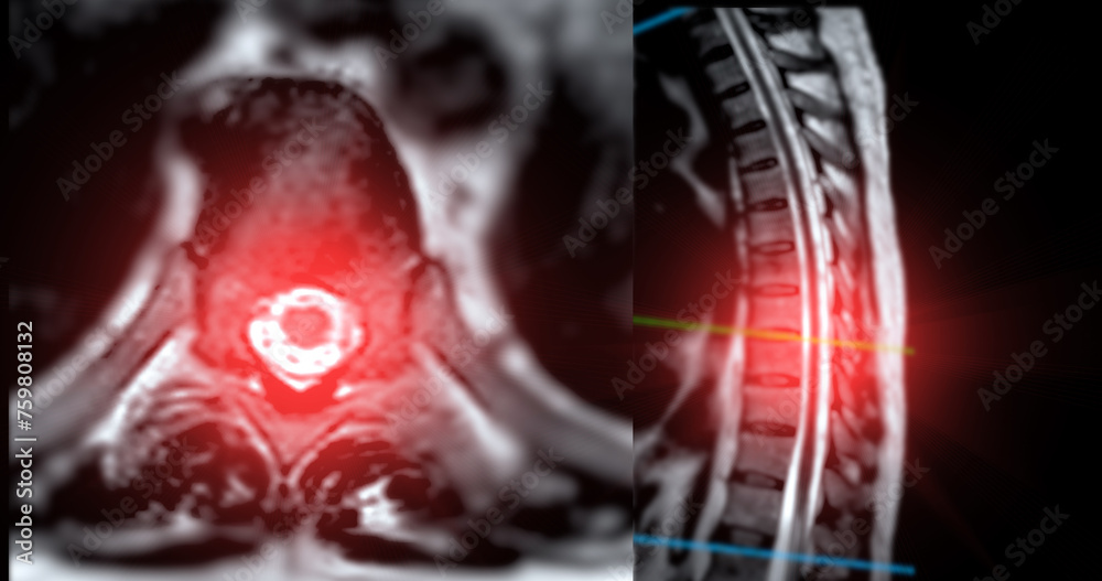 MRI T-L spine or Thoracosacral spine Axial and sagittal T2 technique ...