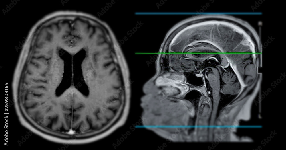 Ilustración de Stock MRI brain scan sagittal plane for detect Brain diseases sush as stroke ...