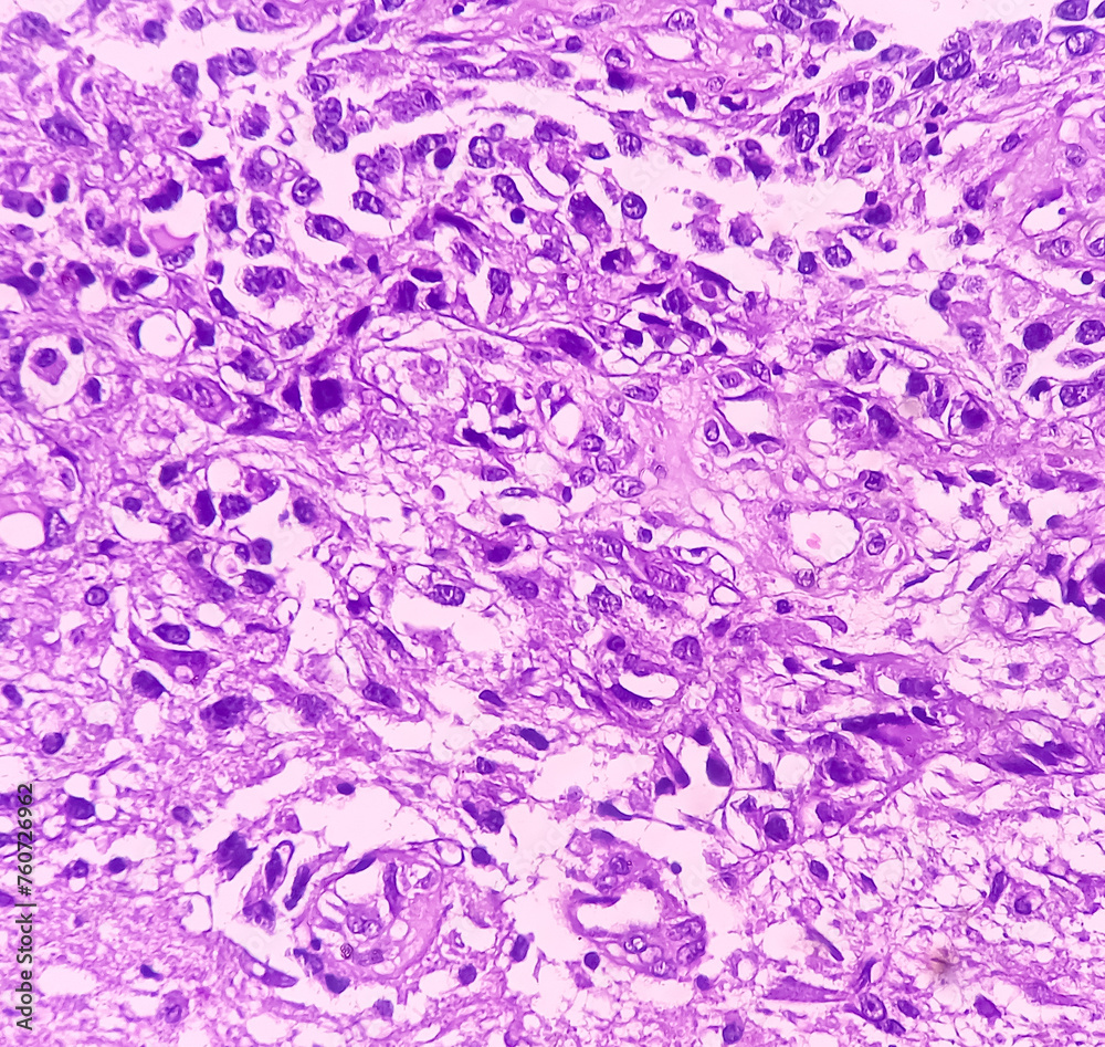 Kidney cancer: Microscopic image of metastatic clear cell carcinoma of ...