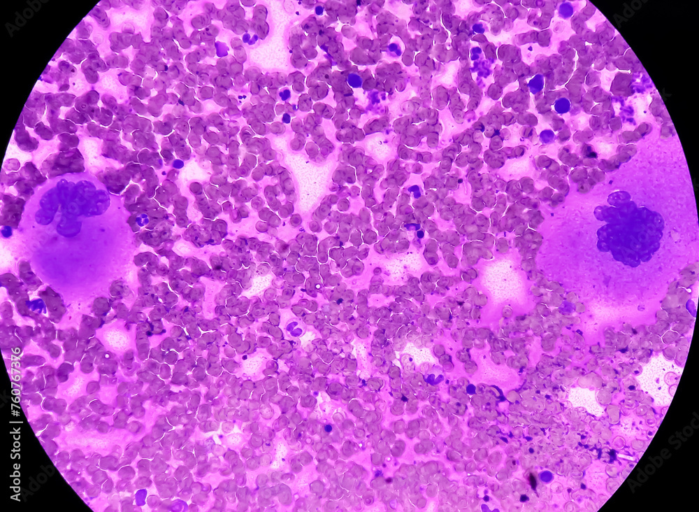 Fotografie Acute leukemia, ALL(Acute lymphoblastic leukemia ...