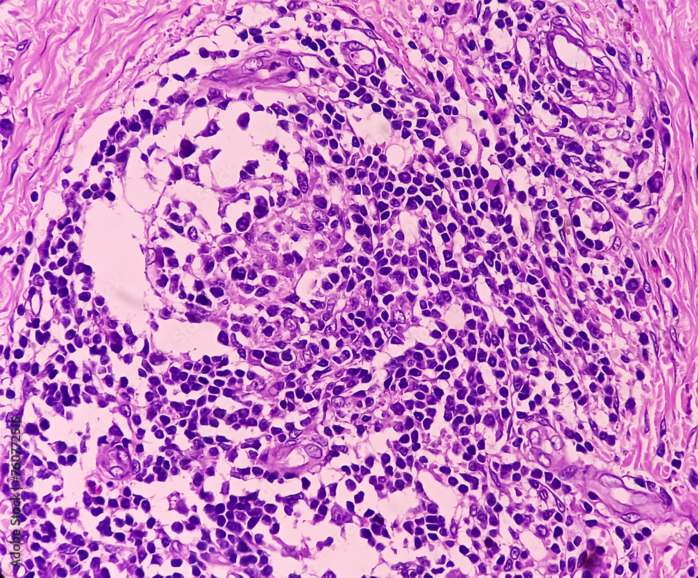 Breast cancer. Invasive squamous cell carcinoma of areola of breast. Show skin and soft tissue ...