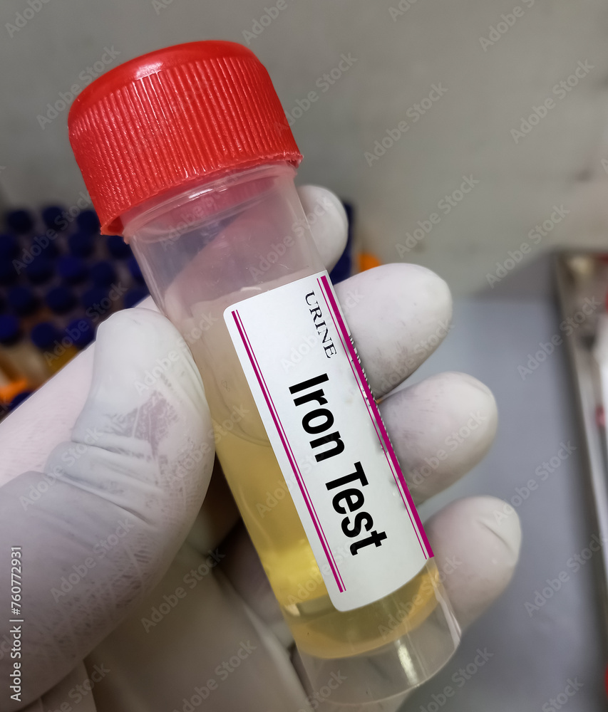 Urine sample for Urinary Iron Level test, to diagnose of iron over load ...