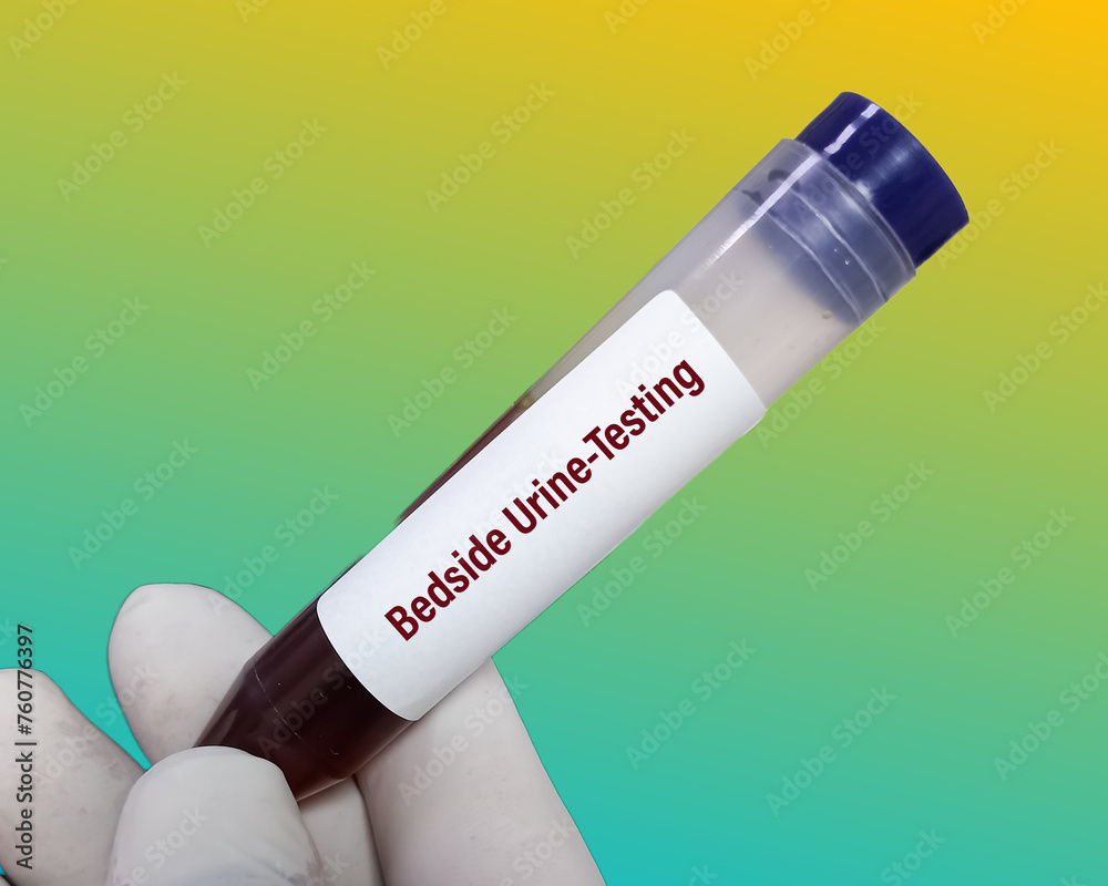 Urine test to look for abnormalities from Bedside Urine, Bedside Urine ...