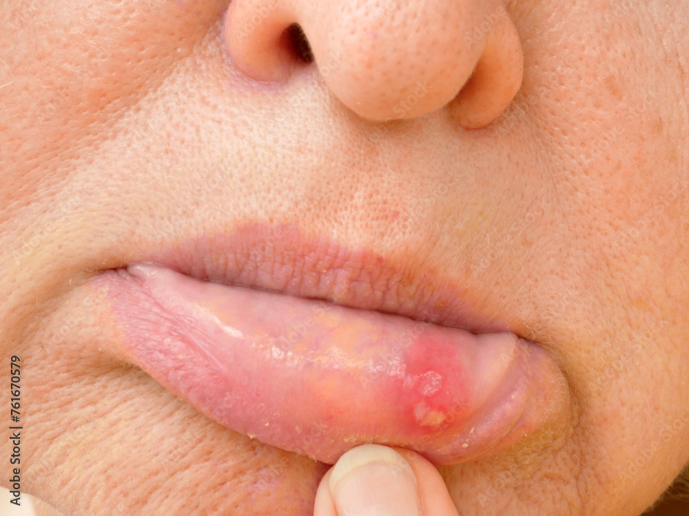 stomatitis in mouth closeup, close-up on the lip with aphthous ...