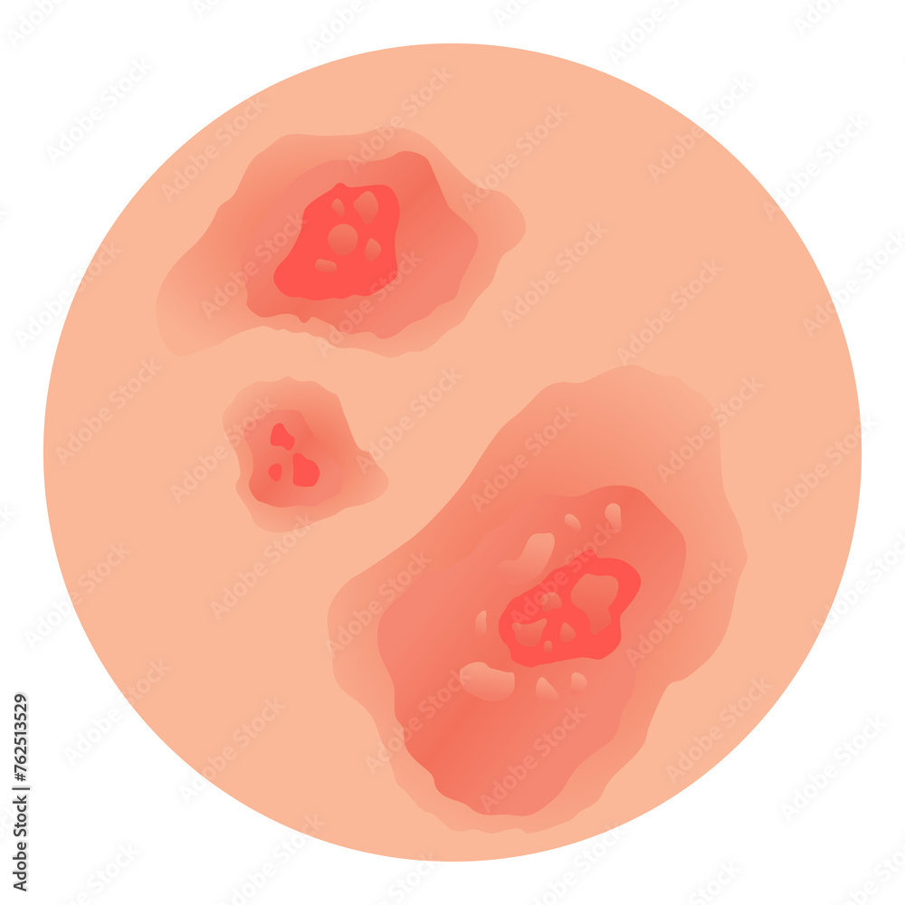 Type of psoriasis . Part of patients skin with dermatitis, inflammation ...