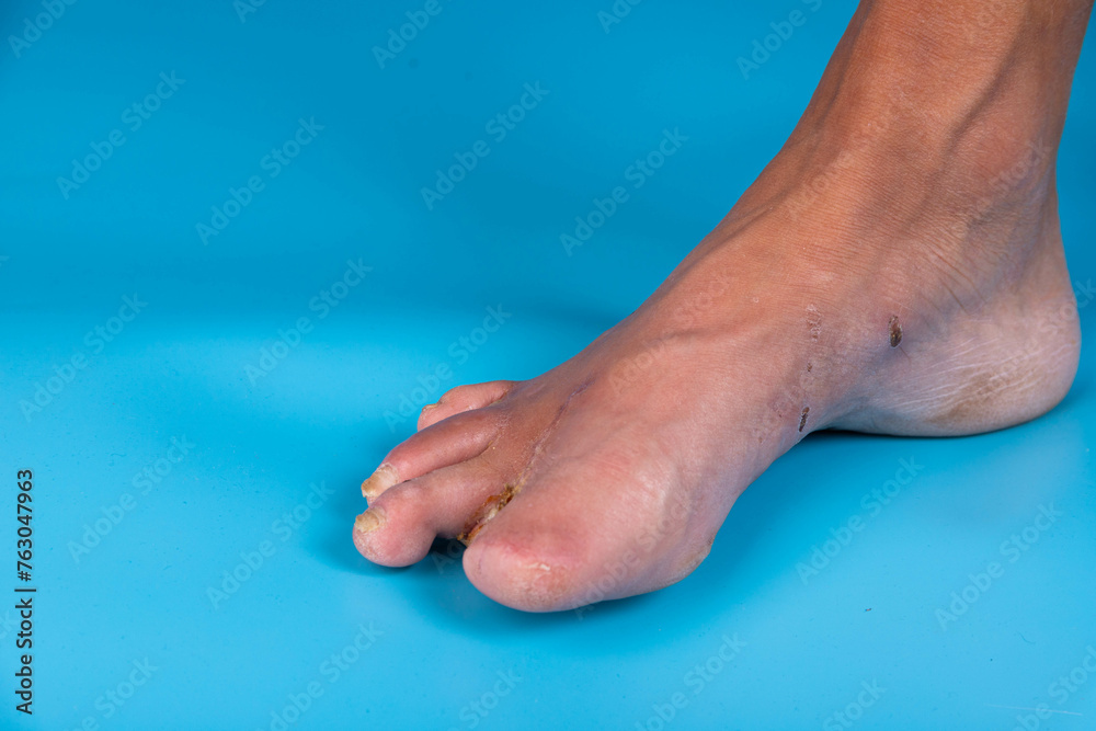 Amputation of diabetic toes of a person on a blue background. Selective ...