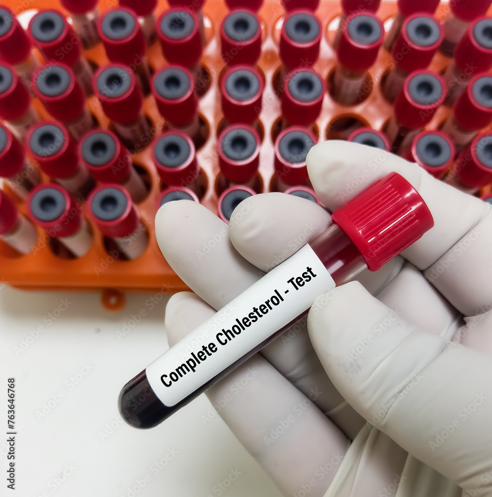 Blood sample for Complete Cholesterol test, Fasting Lipid Profile ...