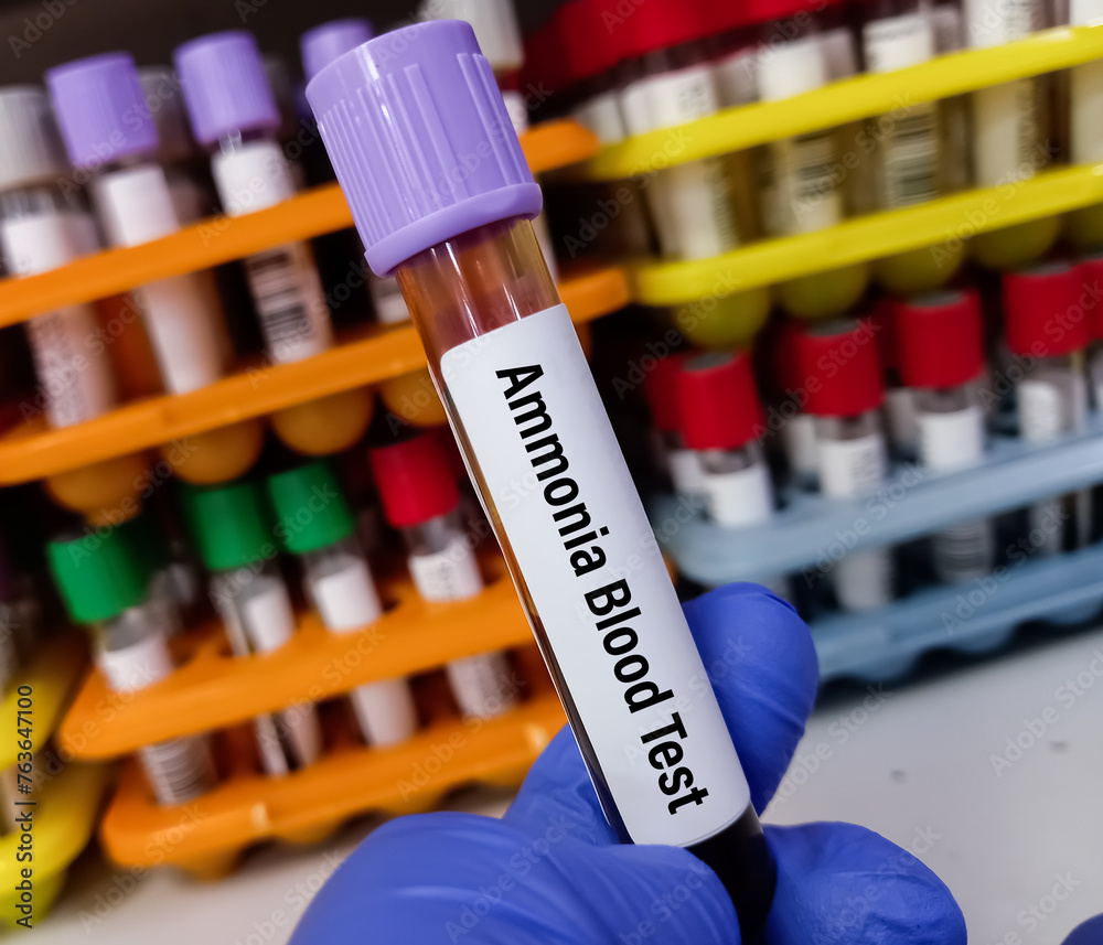 Blood sample for Ammonia test to diagnosis of ammonia levels also known ...