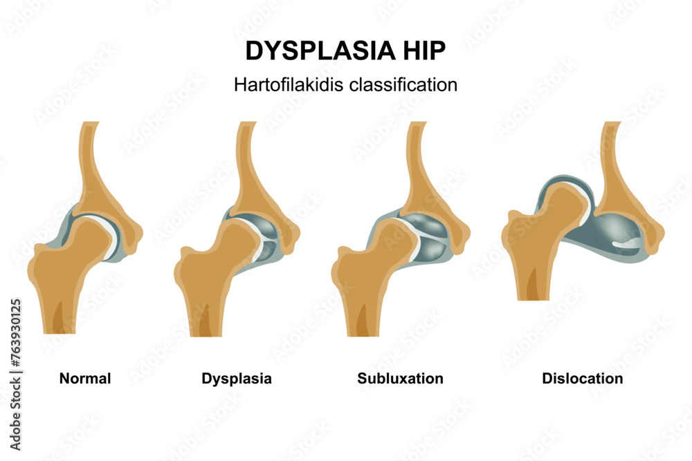 Dysplasia hip classification and types of medical illustration artwork ...
