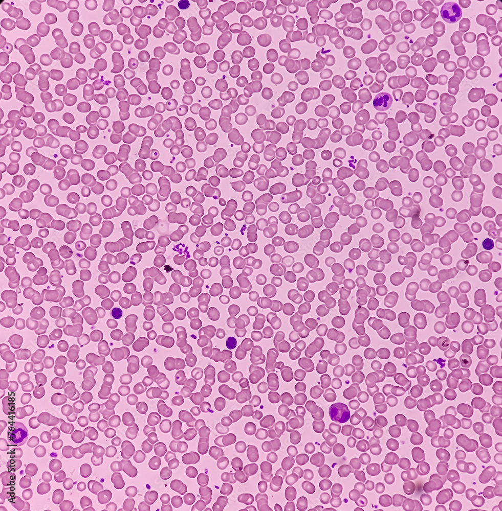 Photomicrograph of hematological slide showing RBC, WBC (Neutrophil ...