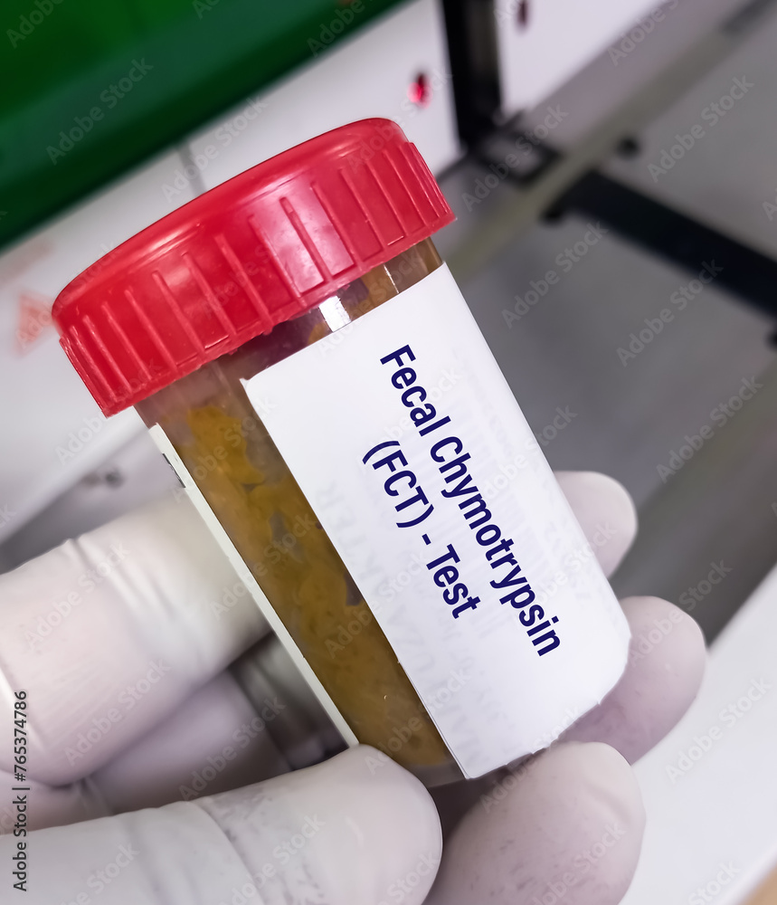 Researcher hold sample in container for Stool Chymotrypsin test with ...