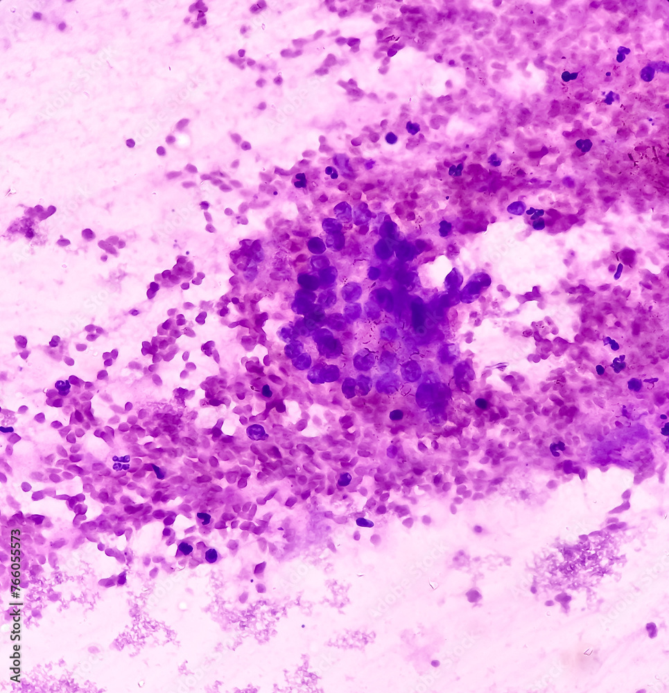 CT guided FNA from lung lesion, Chronic granulomatous inflammation (CGI ...