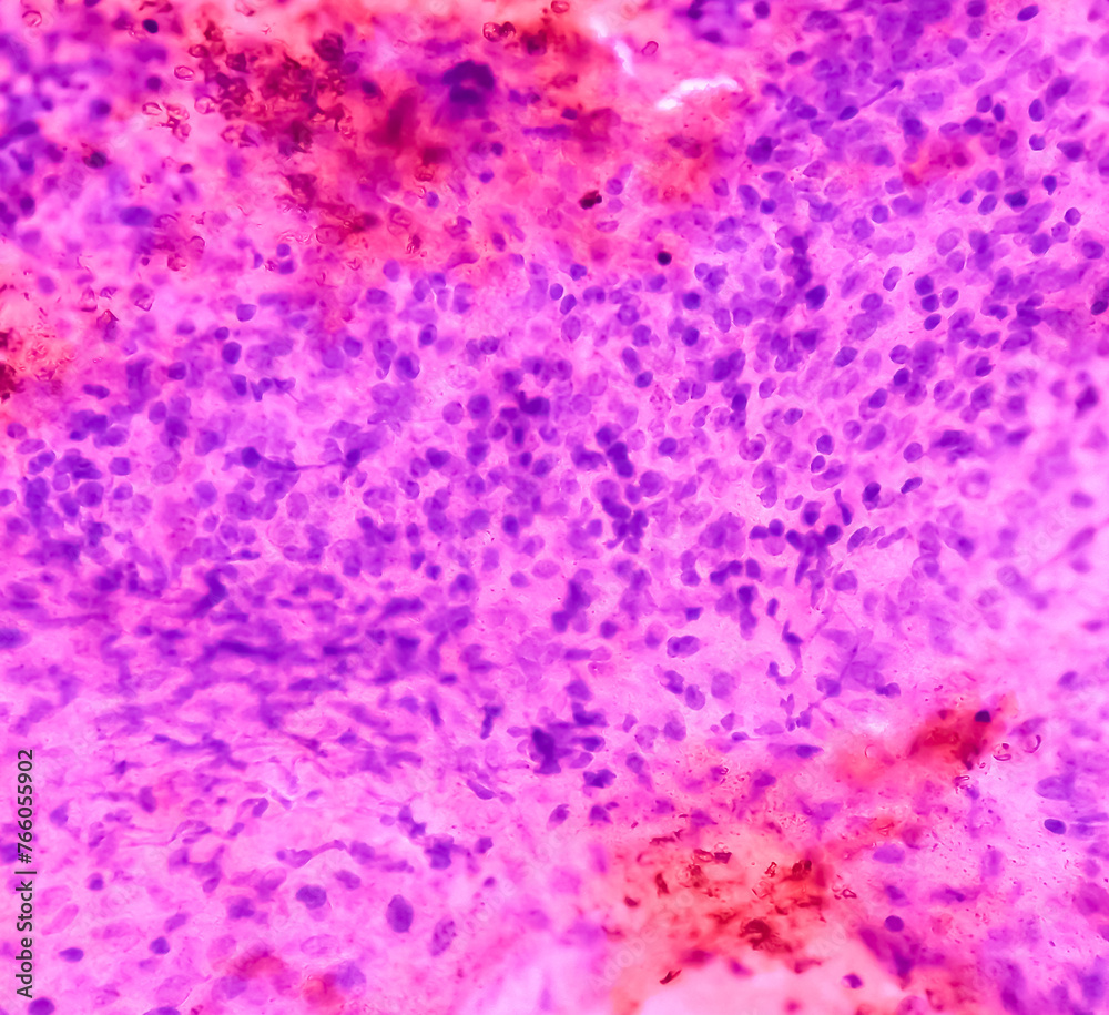 Photomicrograph of Chronic granulomatous inflammation (CGI) with ...