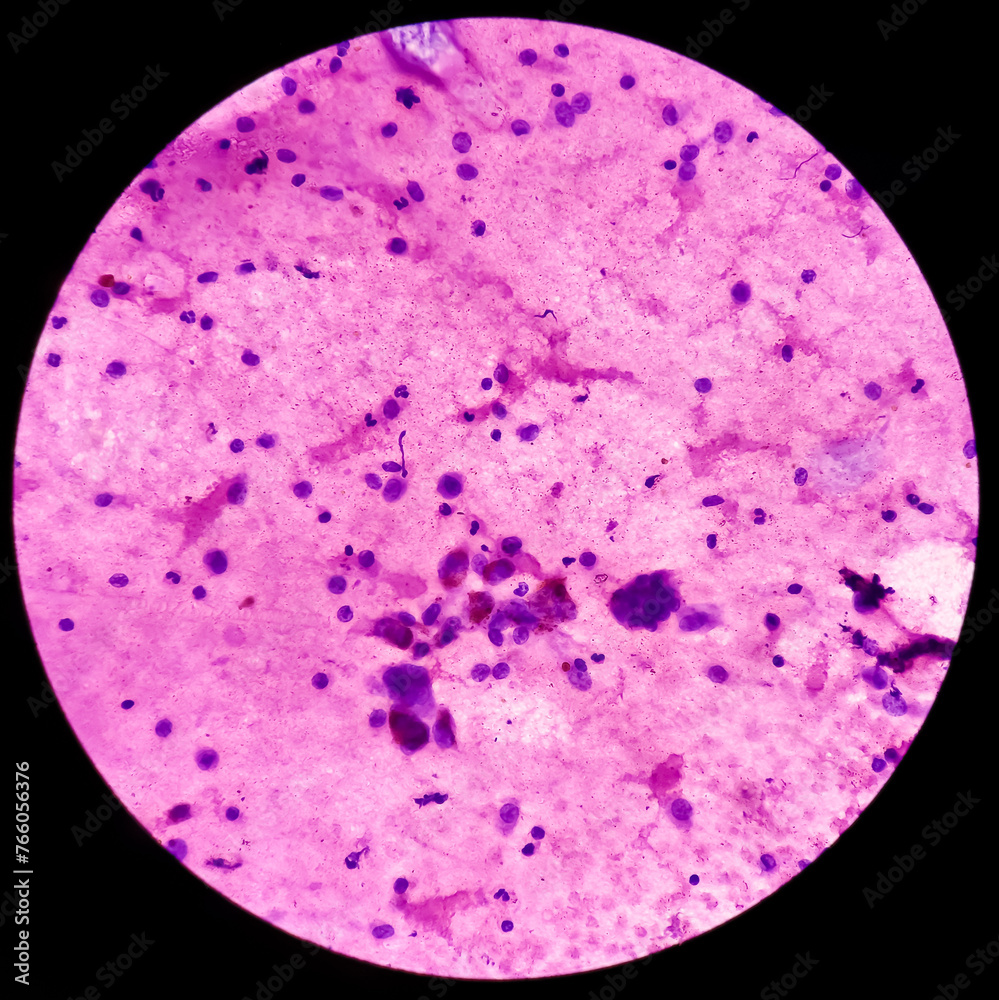Swelling of leg (FNA cytology). Synovitis. smear show polymorphs ...
