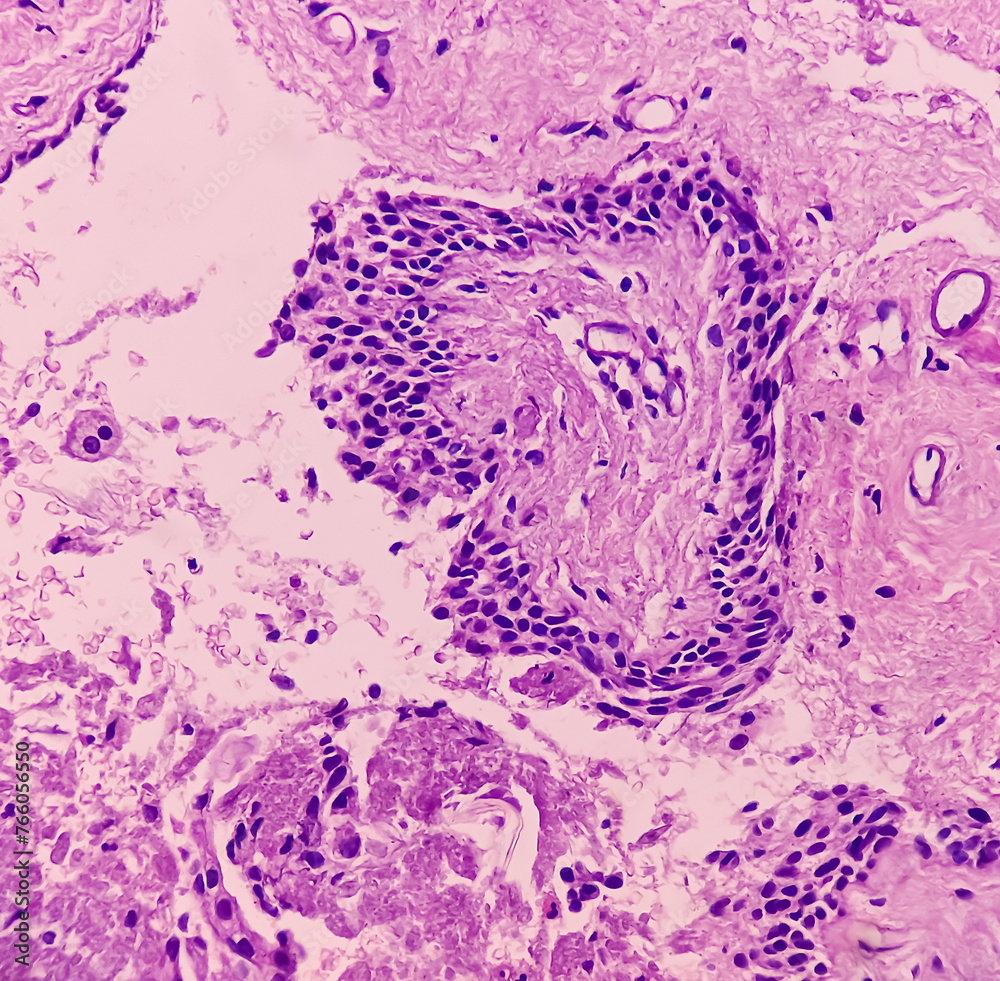 Urachal cyst or Urethral cyst (biopsy). Microscopically show cyst wall ...