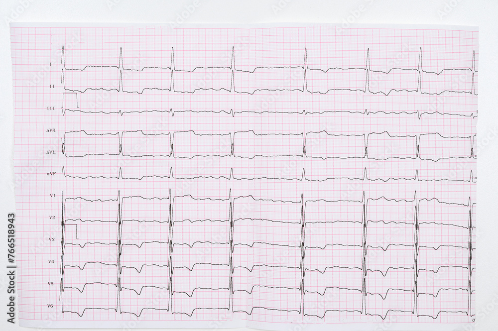 ECG. Subendocardial ischemia, depression of ST segment. Angina pectoris ...