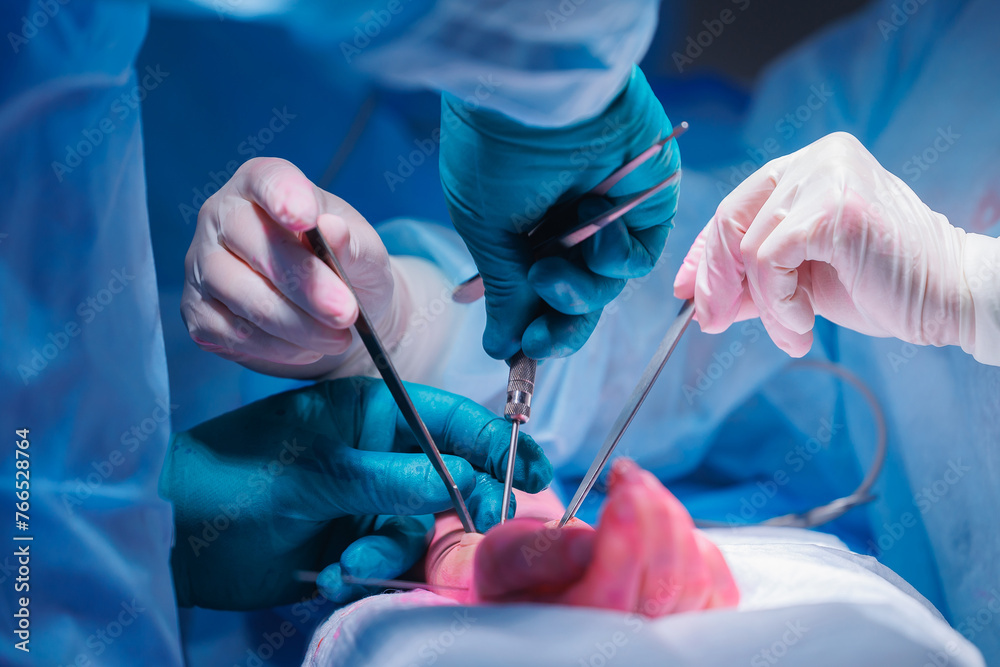 Surgeon installs metal screw pin to fuse radius bones. Surgery to ...