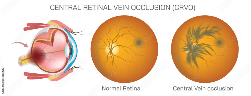 Central retinal vein occlusion is a serious eye condition that occurs ...