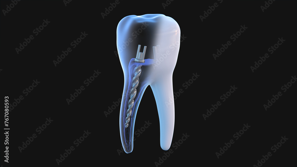 Dental steel post inside molar teeth, Xray view. Dental endodontic ...