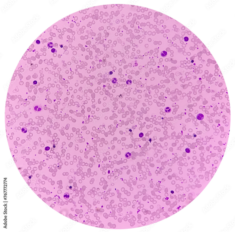 Foto de Stock Blood smear, Hereditary hemolytic anemia. Hemoglobin E ...