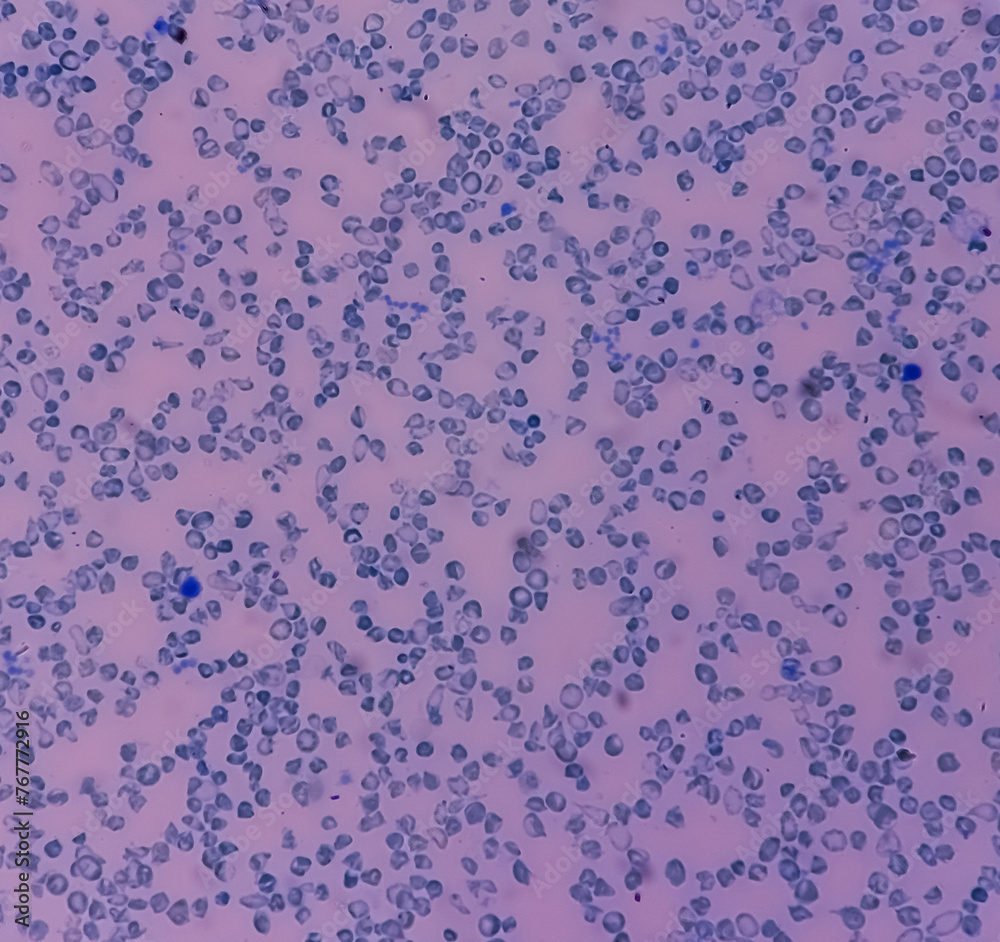 Reticulocyte count under microscope, 100x. methylene blue staining ...