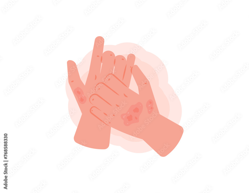 Psoriasis. illustration of hands that feel itchy and a rash appears ...