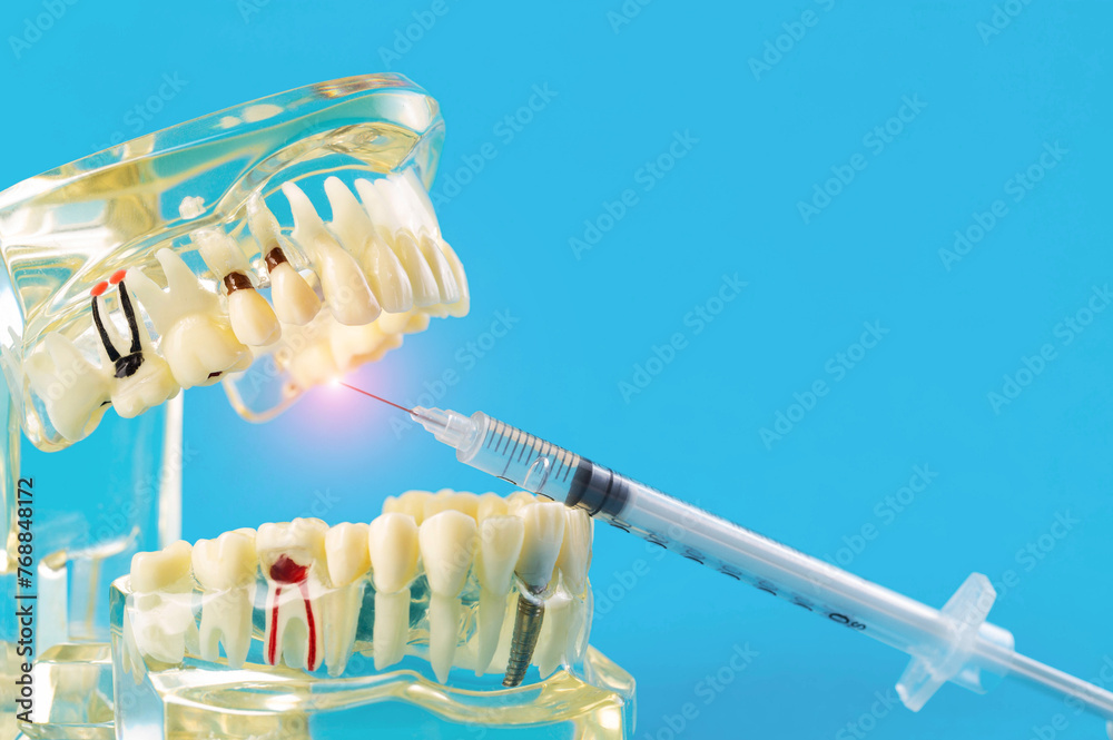 A syringe with an anesthetic anesthetic drug makes an injection into an ...