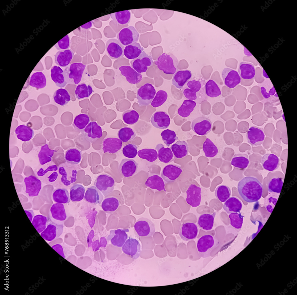 Lymphocytosis with Thrombocytopenia. Smear show white blood cells, red ...