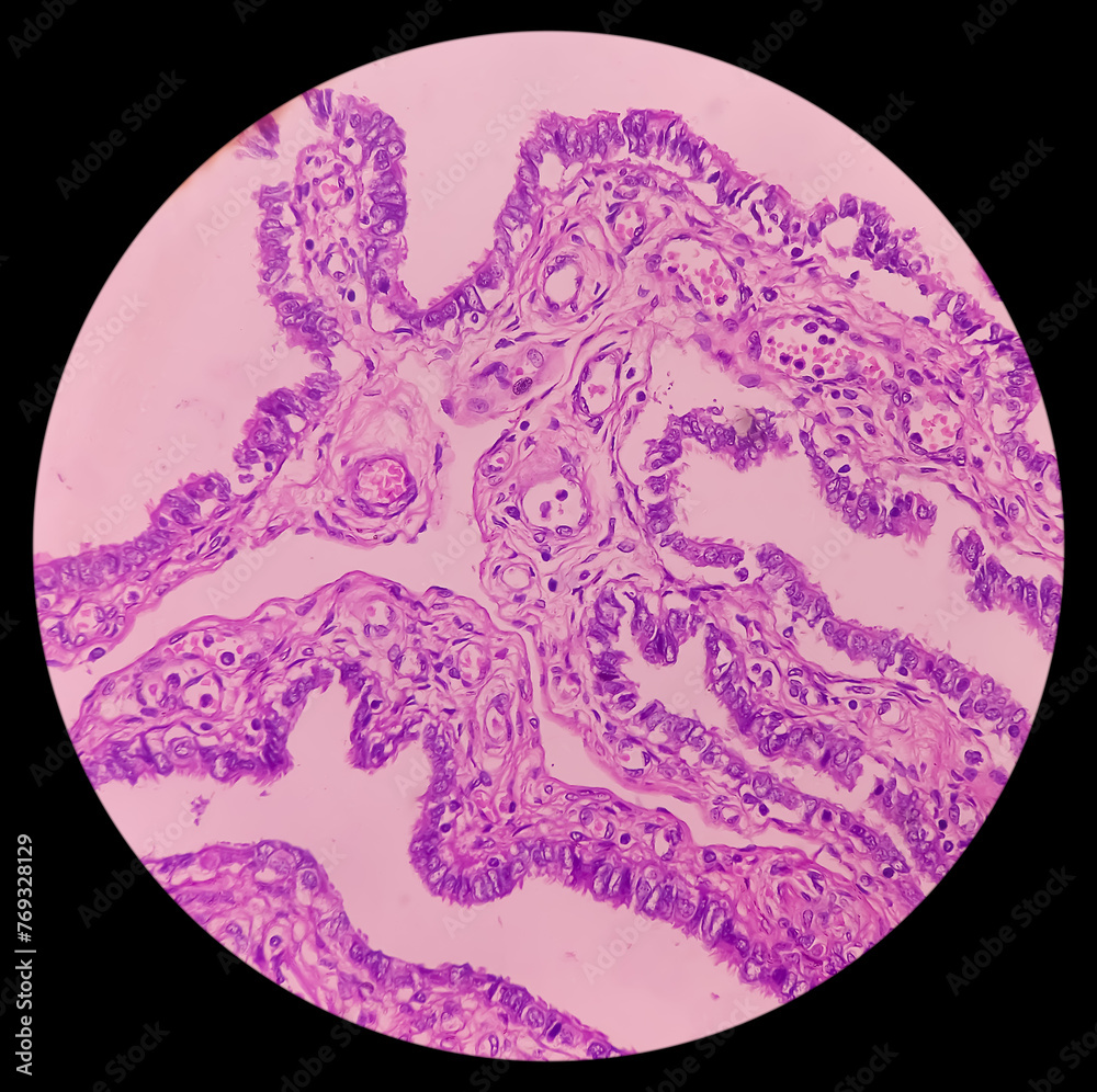 ภาพถ่าย Stock Mature cystic teratoma, Ovarian cyst biopsy, show cyst ...