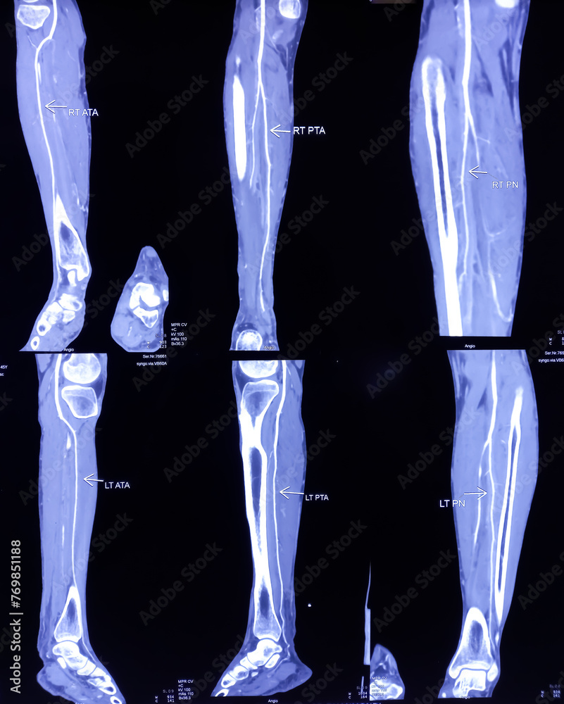 CT angiogram (CTA) shown the abdominal aorta, kidney and common iliac ...