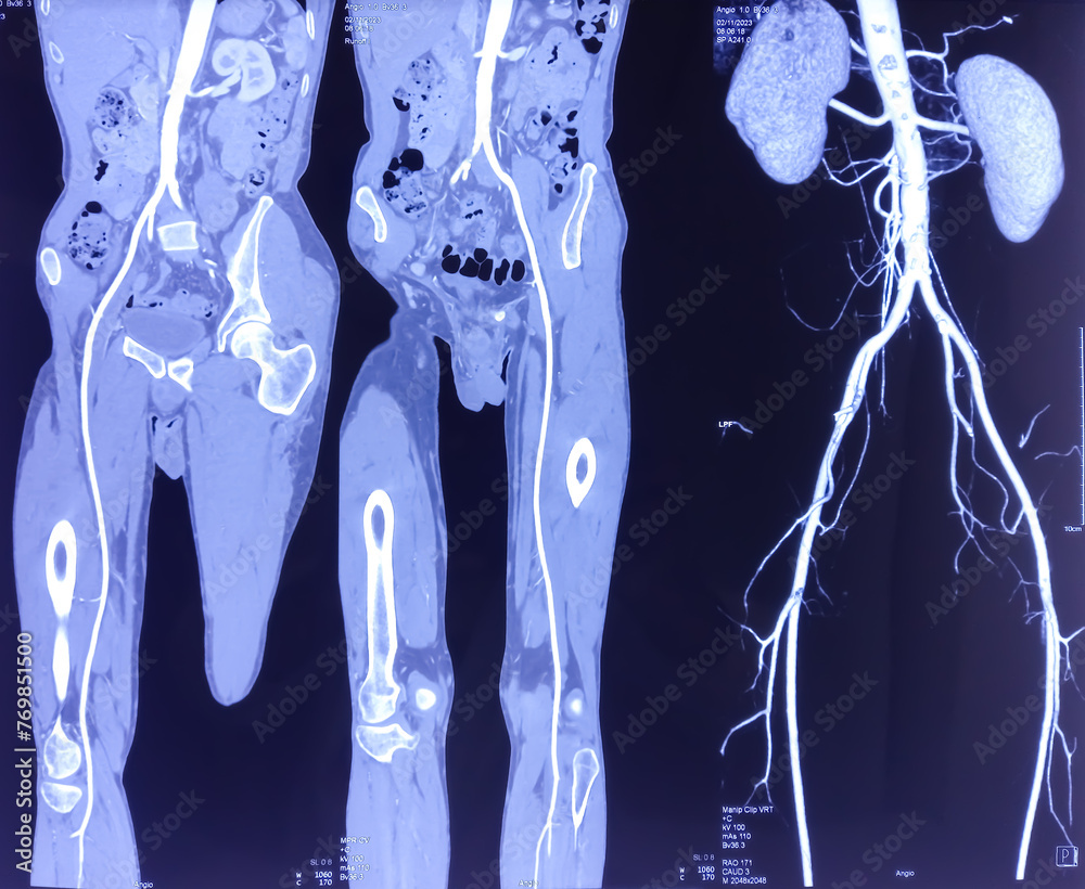 CT angiogram (CTA) shown the abdominal aorta, kidney and common iliac ...