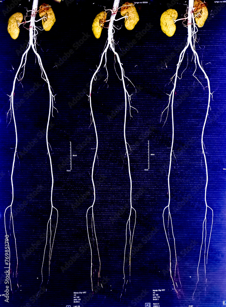 CT angiogram (CTA) shown the abdominal aorta, kidney and common iliac ...