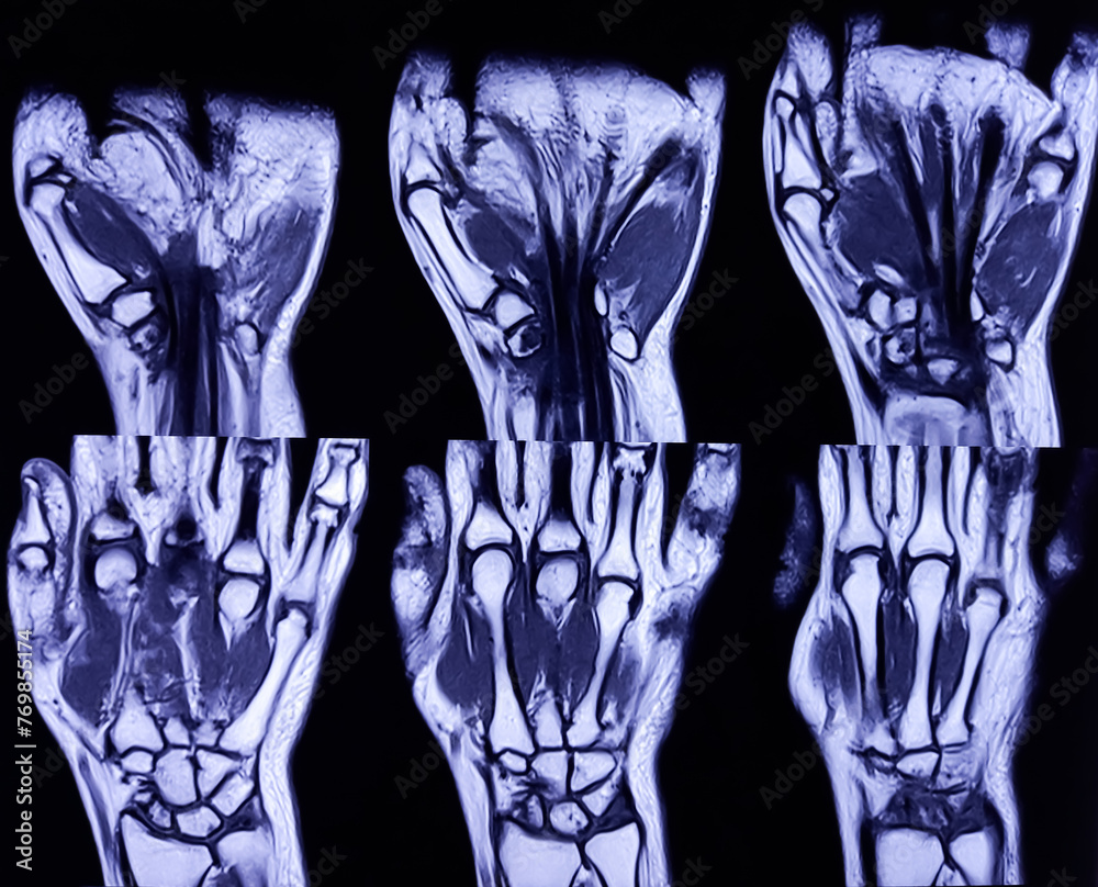 MRI (Magnetic Resonance Imaging) X-ray image of human hand from various ...