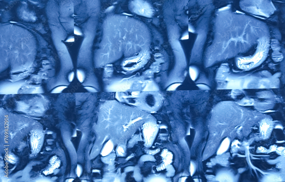 MRCP film of MRI of abdomen. Hepatic parenchymal tiny calcification ...